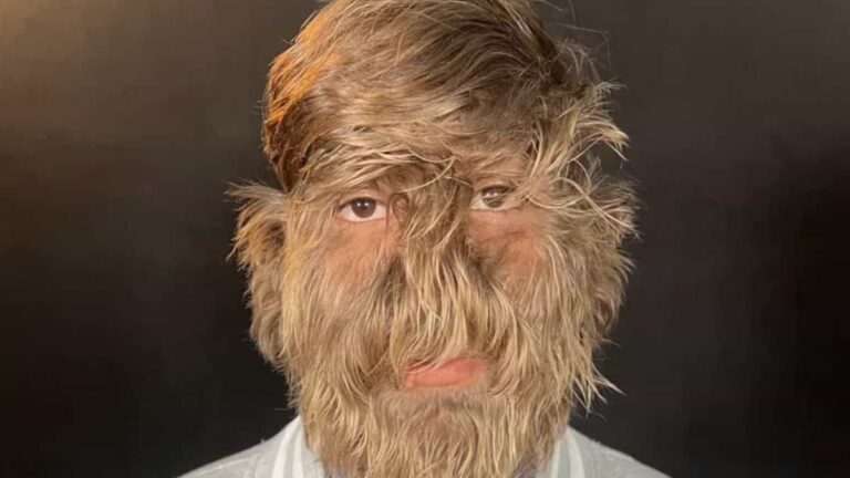 Suffering from a rare condition, this 18-year-old sets the record for ...